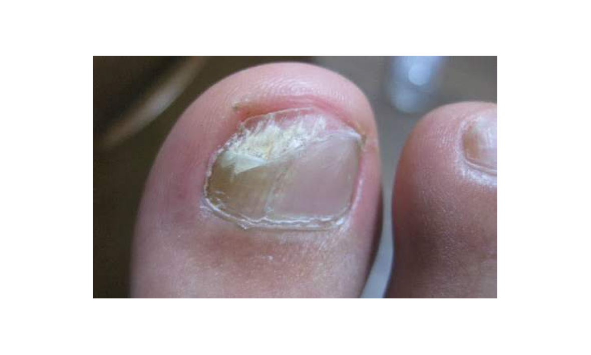 Onicomicose :: Estetica-e-podologia-leonor-vieira